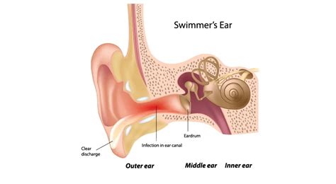 Swimmers Ear Signs And Symptoms Ear Canal Ent