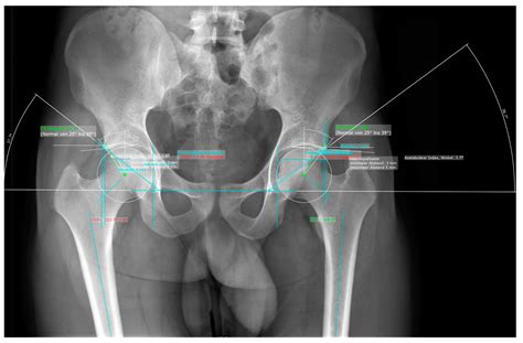 Osteoarthritis Hip X Ray Findings