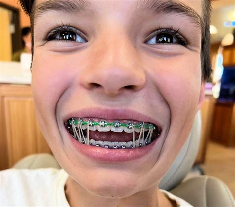 Teethbraces On Tumblr
