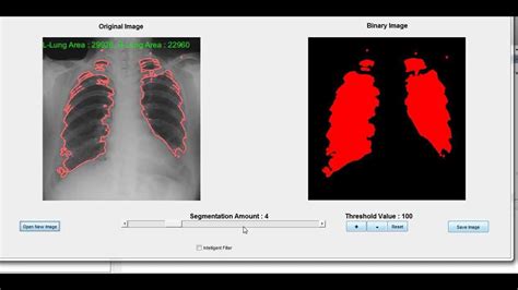 Lung Segmentation Glimpse A Matlab Gui Youtube