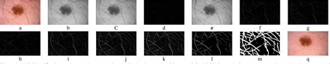 Figure 2 From Hair Removal On Dermoscopy Images Semantic Scholar