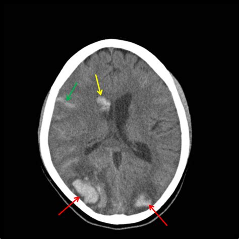Intracerebral Hemorrhage Mri