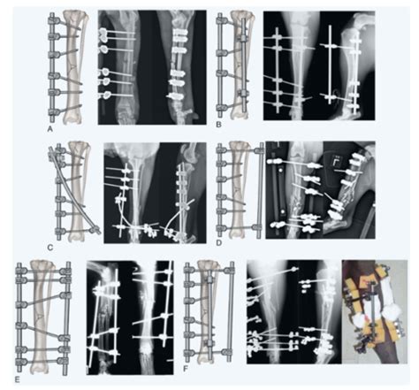 Tobias Ch 42 External Skeletal Fixation Flashcards Quizlet