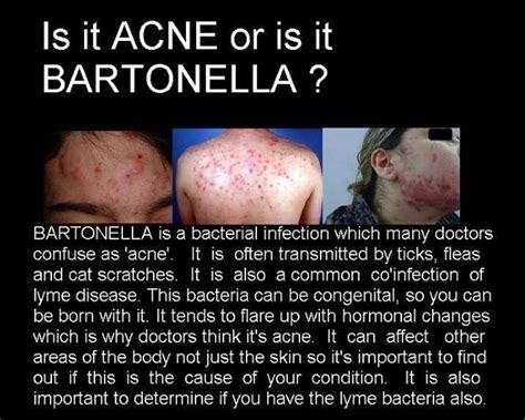 Lyme Disease And Bartonella Infections