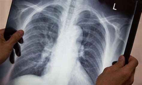Ai Improves Lung Nodule Detection On Chest X Rays Medical Dialogues