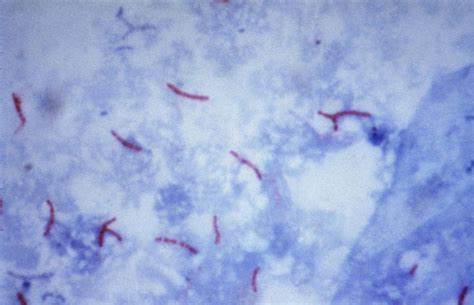 Cancer Therapies Show Promise In Combating Tuberculosis