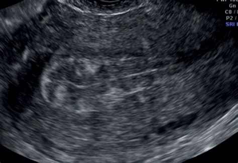Endometrium Ultrasound