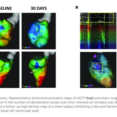 Scar Detection By Endocardial Mapping High Density Endocardial Mapping