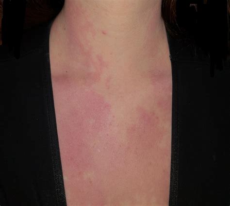 Rosacea On Neck