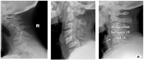 Classification Of Cervical Spine Fracture And Dislocation Using Refined