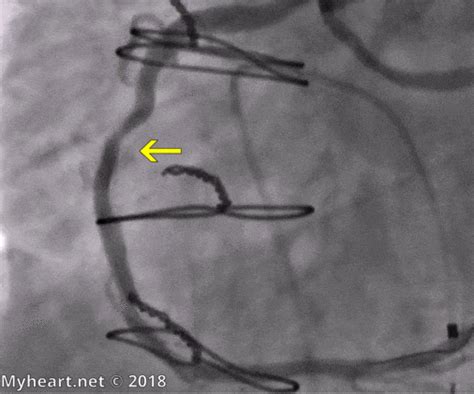 How Long Should I Take My Plavix After Stenting • Myheart