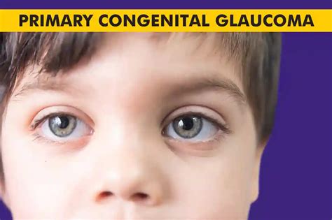 Congenital Glaucoma Causes Symptoms And Treatment Options