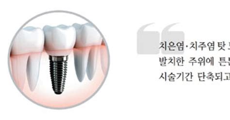 오래가는 인공치아 임플란트