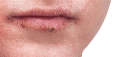 Eczeem Lippen Oorzaak En Tips Sproet