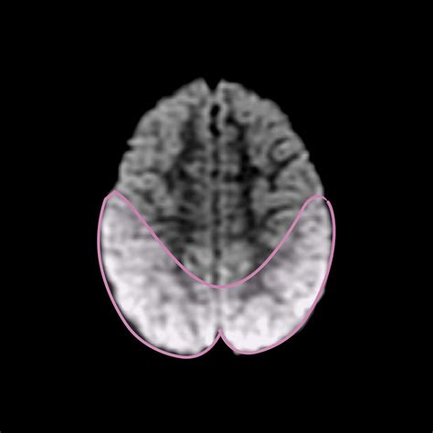 Neuroanatomy Glossary Anoxic Encephalopathy Ditki Medical
