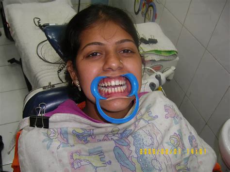 Composite Filling Ppt