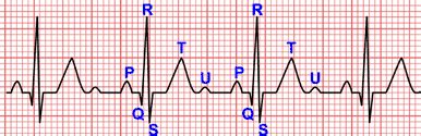 Atrial Flutter Electrocardiogram Characteristics