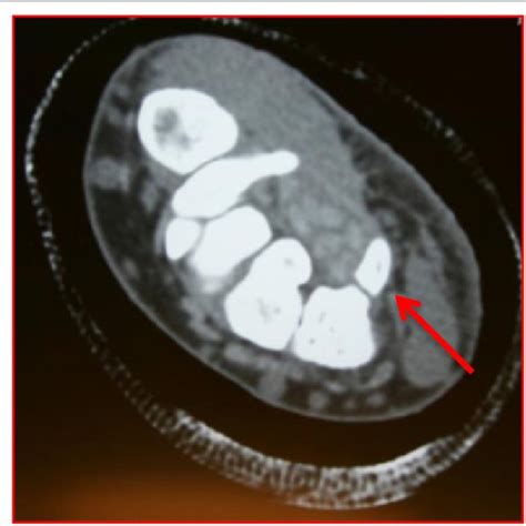 Plate And Screw Fixation Of An Angulated Fifth Metacarpal Neck Fracture Download Scientific
