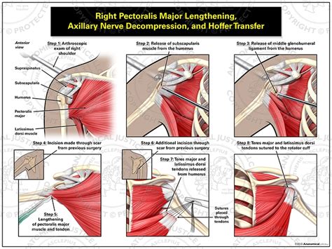 Right Pectoralis Major Lengthening