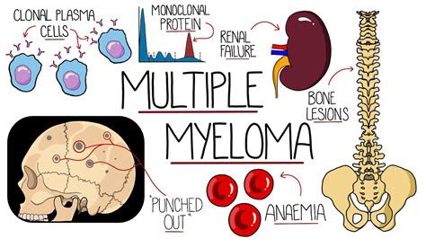 Understanding Multiple Myeloma Multiple Myeloma Explained Clearly Youtube