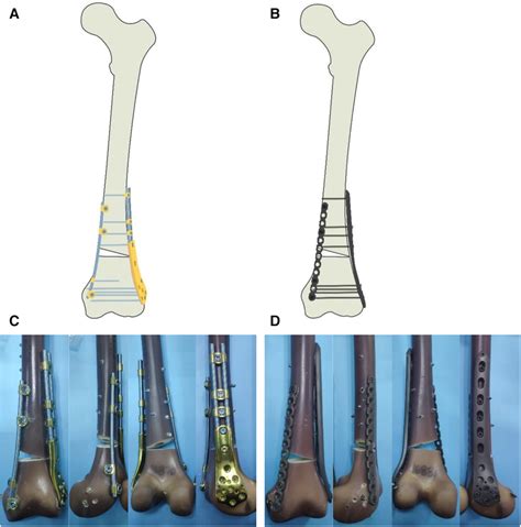 A Model Of Ao Ota Classification A3 Fracture Of Distal Femur Fixed