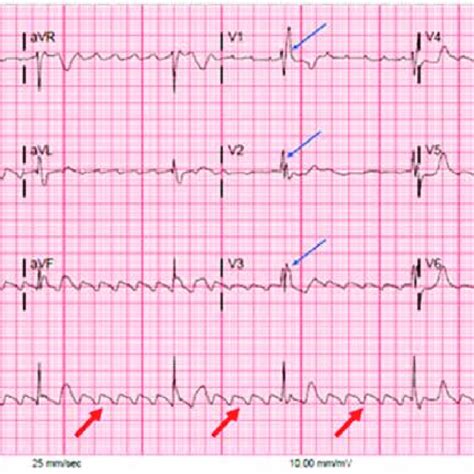 Admission Electrocardiogram Revealing Typical Atrial Flutter Red