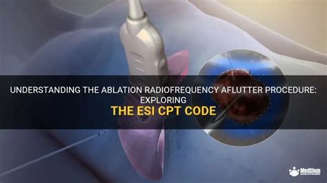 Understanding The Ablation Radiofrequency Aflutter Procedure Exploring The Esi Cpt Code MedShun