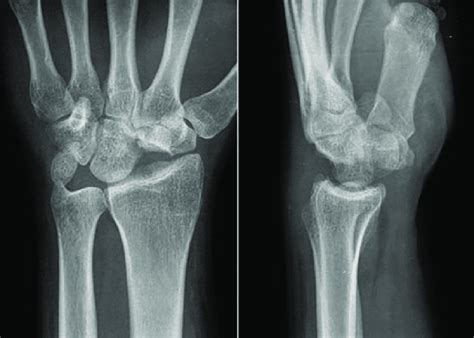 After Proximal Row Carpectomy The Shorter Radius Of Curvature Head Of Download Scientific