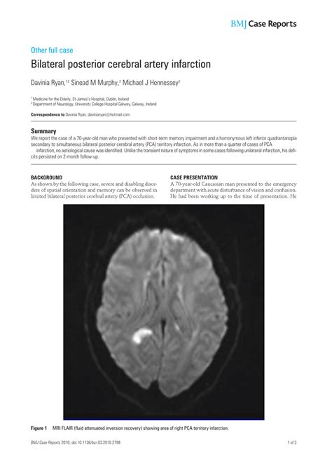 Posterior Cerebral Artery Stroke