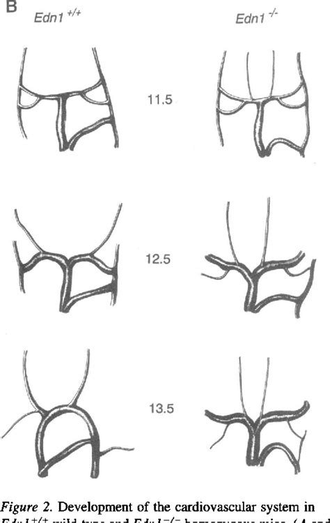 Figure 2 From Aortic Arch Malformations Semantic Scholar