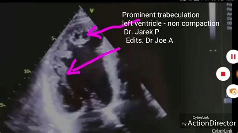 Non Compaction Cardiomyopathy Echo Video Youtube