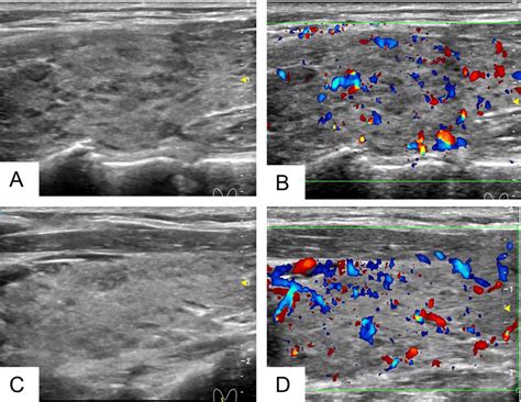 The Longitudinal View Of The Right Lobe Of The Thyroid Gland Using