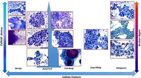 Classification Of Thyroid Fine Needle Aspiration Cyto