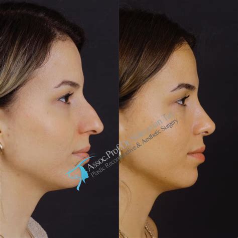 Before And After Rhinoplasty Photos Nose Job Before Afters Artofit