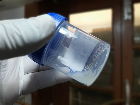 Esame Spermiogramma Analisi Cruciale Per La Salute Maschile