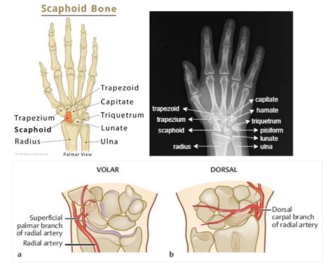 Scaphoid Fracture Avascular Necrosis