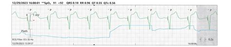 Pacemaker Basics Straight A Nursing