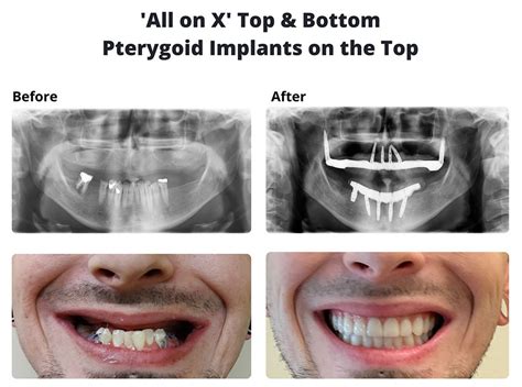 Zygomatic Arch Implants
