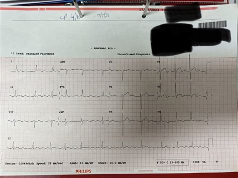 A Flutter With Variable Block R Ekgs