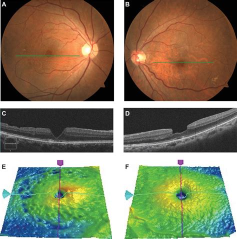Figure 1 From Retinal Thickness After Vitrectomy And Internal Limiting Membrane Peeling For