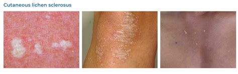 Dermatology 101 Conditions 81 100 Gp Exams