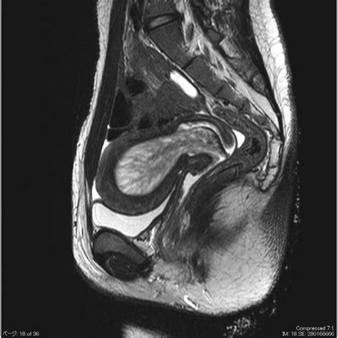 Hysteroscopy Found No Obvious Proliferative Lesion In The Patients Uterus Download
