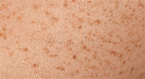 Close Up View Of Freckles On Light Skin Texture Background For Medical