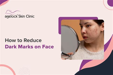 How To Reduce Dark Marks On Face Agelock Skin Hair Clinic