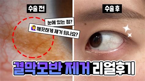 [동민신tv] 내 눈에 생긴 점 결막모반제거 치료과정 보여드립니다 Youtube