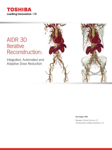 Ct Wp Aidr 3d Iterative Reconstruction Dose Reduction 2012 Pdf Ct
