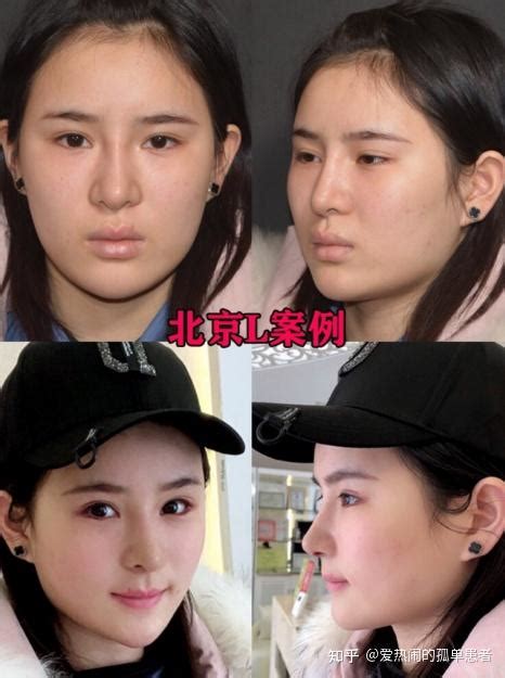 自然妈生鼻修复大佬盘点：北京、深圳、上海、重庆、杭州 知乎