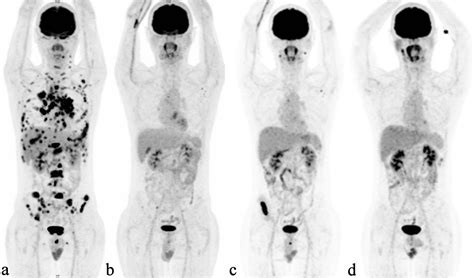 Pet Scan Lymphoma
