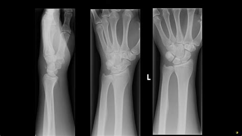 Xray Lt Wrist Emergucate