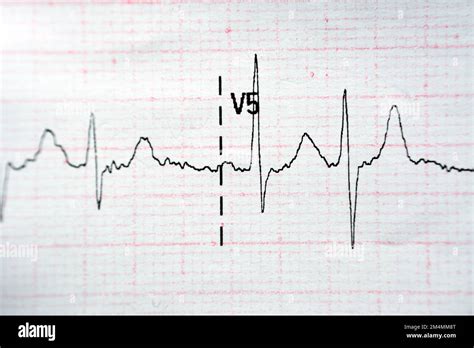 Ecg Electrocardiograph Paper That Shows Normal Sinus Rhythm Nsr With